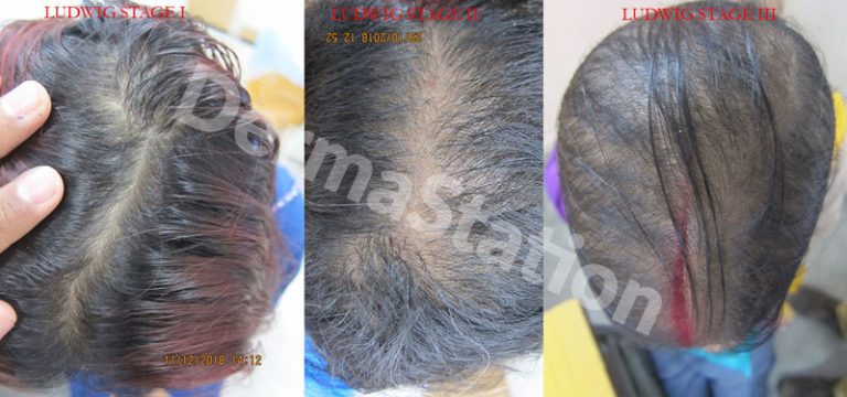 dermatologist in jankapuri, Hair Loss Treatment jankapuri – Blog